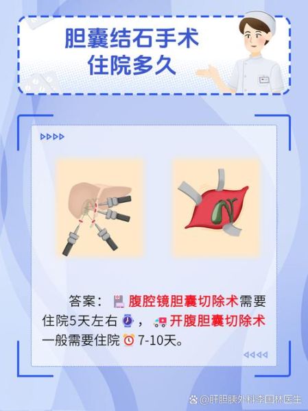 胆结石手术住院几天_术后多久能出院-第2张图片-山城妙识