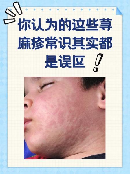 荨麻疹是因为太脏吗_荨麻疹和卫生差有关吗-第1张图片-山城妙识 荨麻疹是因为太脏吗_荨麻疹和卫生差有关吗-第1张图片-山城妙识