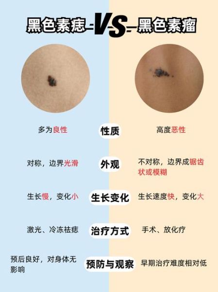 色素痣会癌变吗_色素痣去除方法-第2张图片-山城妙识