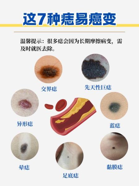 色素痣会癌变吗_色素痣去除方法-第1张图片-山城妙识