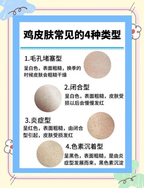 鸡皮肤怎么改善_鸡皮肤用什么身体乳最有效-第3张图片-山城妙识
