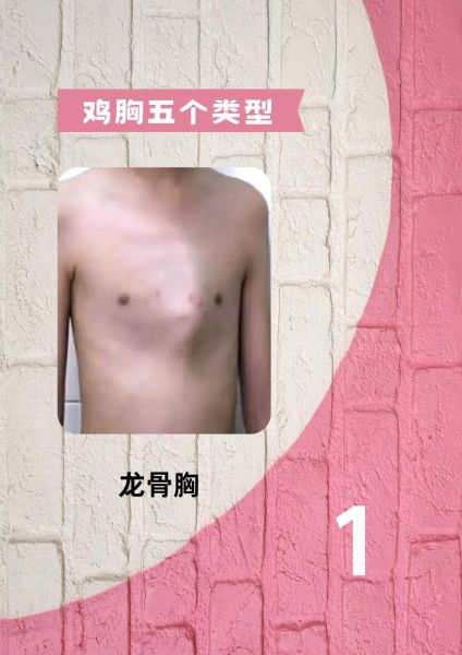 轻微鸡胸怎么自己矫正_鸡胸自我矫正动作-第3张图片-山城妙识