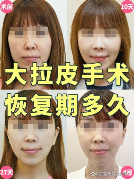 面部拉皮手术怎么做_面部拉皮能维持多久-第2张图片-山城妙识 面部拉皮手术怎么做_面部拉皮能维持多久-第2张图片-山城妙识