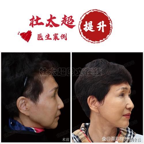 面部拉皮手术怎么做_面部拉皮能维持多久-第3张图片-山城妙识 面部拉皮手术怎么做_面部拉皮能维持多久-第3张图片-山城妙识