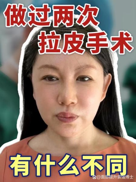面部拉皮手术怎么做_面部拉皮能维持多久-第1张图片-山城妙识 面部拉皮手术怎么做_面部拉皮能维持多久-第1张图片-山城妙识