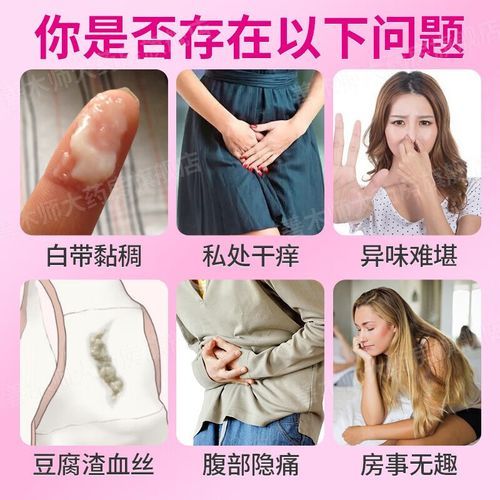豆腐渣白带怎么治疗_豆腐渣白带用什么药-第1张图片-山城妙识