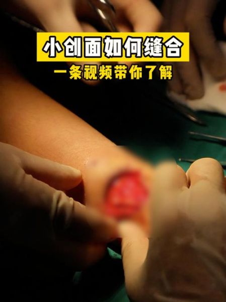 清创手术怎么做_清创缝合术后注意事项-第2张图片-山城妙识 清创手术怎么做_清创缝合术后注意事项-第2张图片-山城妙识