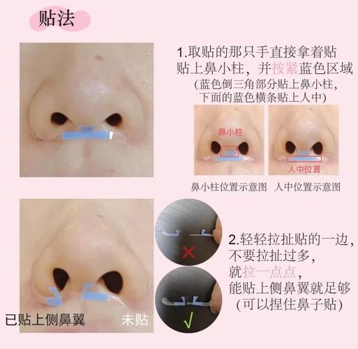 蒜头鼻怎么自己矫正_蒜头鼻自然缩小方法-第2张图片-山城妙识