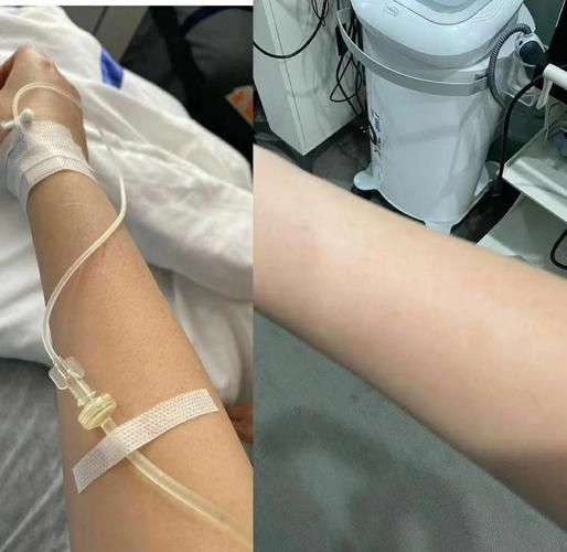 美白针效果能维持多久_打美白针安全吗-第2张图片-山城妙识