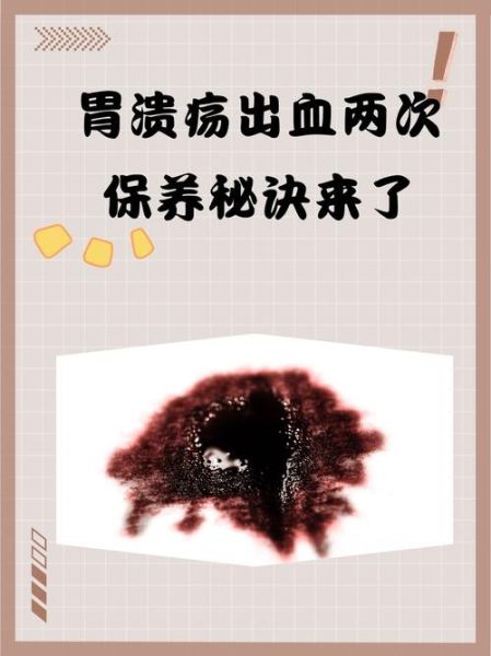 酒后胃出血能自愈吗_酒后胃出血多久能好-第1张图片-山城妙识