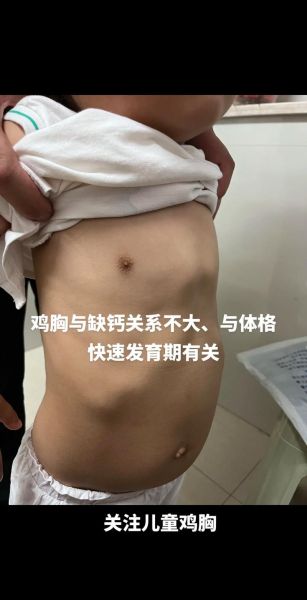 鸡胸图正确对照图_鸡胸矫正动作图解-第2张图片-山城妙识