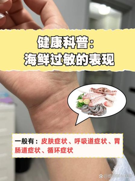 吃海鲜过敏症状_吃海鲜过敏怎么办-第3张图片-山城妙识 吃海鲜过敏症状_吃海鲜过敏怎么办-第3张图片-山城妙识