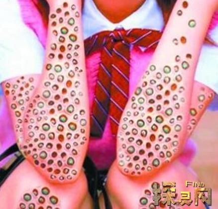 蓬蓬乳是什么_蓬蓬乳怎么治疗-第1张图片-山城妙识 蓬蓬乳是什么_蓬蓬乳怎么治疗-第1张图片-山城妙识