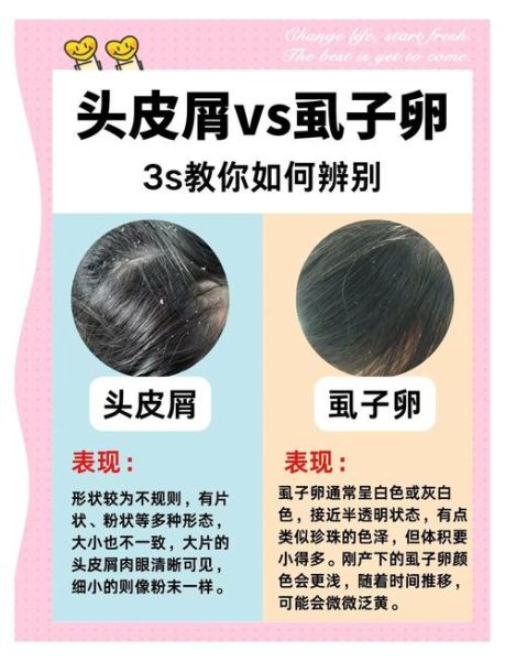 虱子卵长什么样_如何彻底清除虱子卵-第2张图片-山城妙识