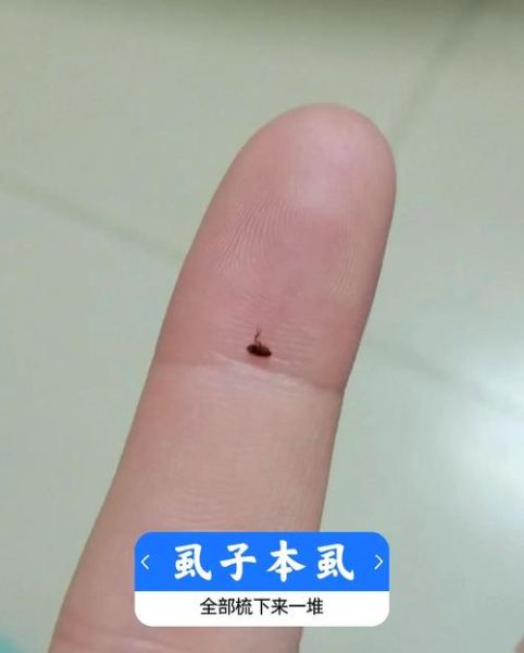 虱子卵长什么样_如何彻底清除虱子卵-第3张图片-山城妙识