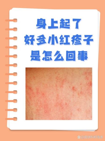 身上皮肤过敏图片大全_如何快速辨别-第3张图片-山城妙识 身上皮肤过敏图片大全_如何快速辨别-第3张图片-山城妙识
