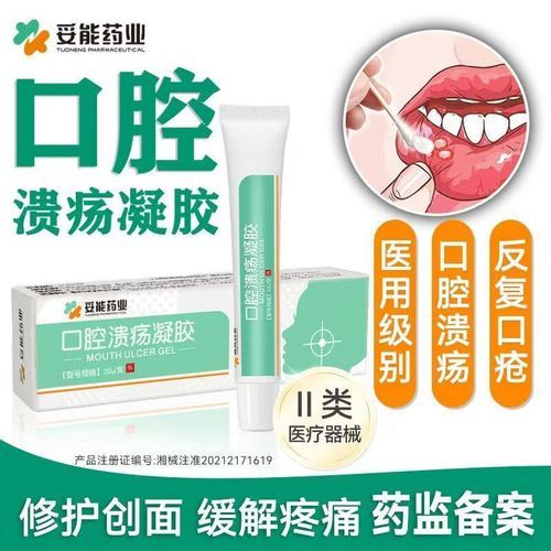 口腔溃疡特效药有哪些_怎么快速止痛-第1张图片-山城妙识