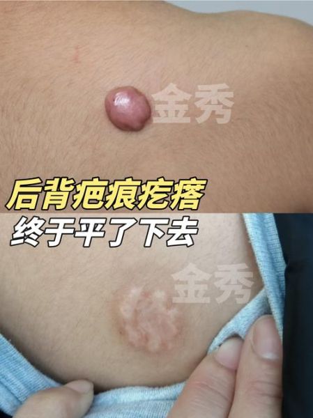 疙瘩疤痕怎么消除_疙瘩疤痕会自己消失吗-第2张图片-山城妙识
