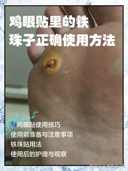 鸡眼怎么治疗能除根_鸡眼贴多久能好-第2张图片-山城妙识