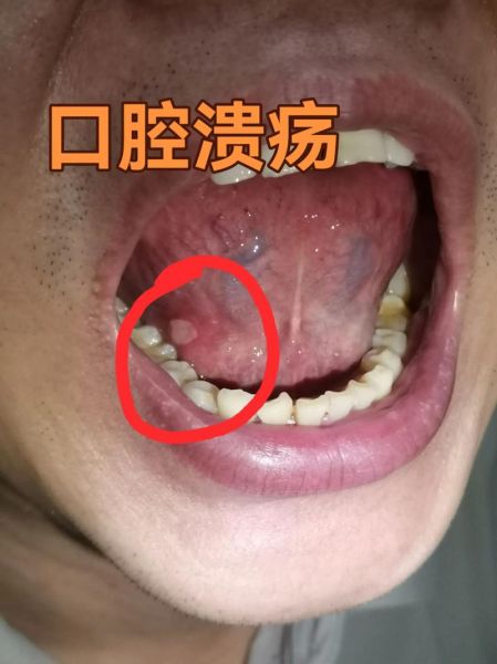 口腔溃疡怎么快速止痛_口腔溃疡立刻止疼的方法-第2张图片-山城妙识