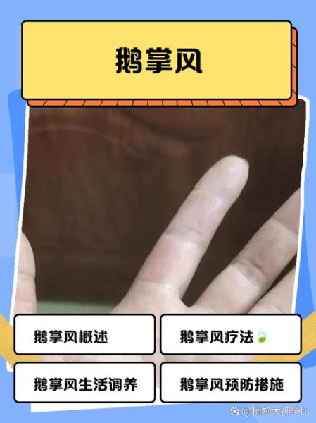 鹅掌风是什么原因引起的_鹅掌风是怎么得的-第3张图片-山城妙识