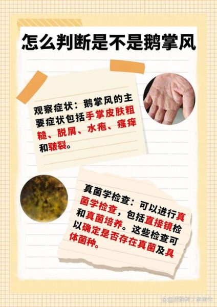 鹅掌风是什么原因引起的_鹅掌风是怎么得的-第2张图片-山城妙识