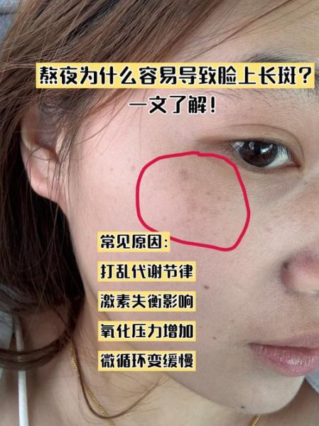 吃黑芝麻三年长斑了_黑芝麻祛斑还是致斑-第3张图片-山城妙识