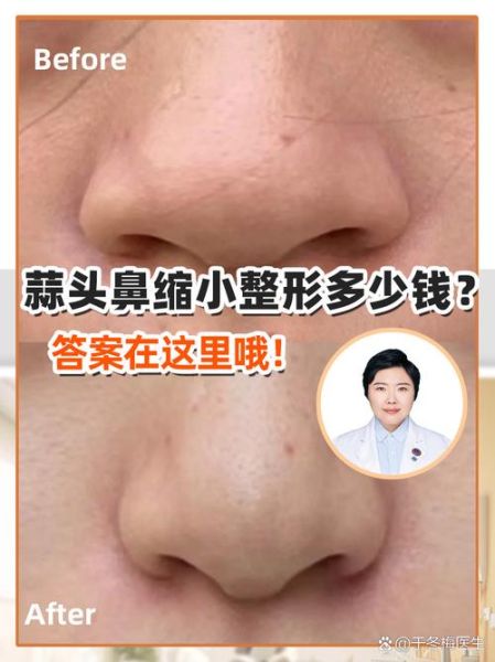蒜头鼻整形价格_蒜头鼻整形多少钱-第2张图片-山城妙识 蒜头鼻整形价格_蒜头鼻整形多少钱-第2张图片-山城妙识
