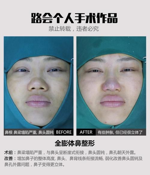 蒜头鼻整形价格_蒜头鼻整形多少钱-第3张图片-山城妙识 蒜头鼻整形价格_蒜头鼻整形多少钱-第3张图片-山城妙识