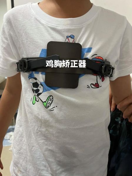 鸡胸脯怎么矫正_鸡胸脯矫正方法有哪些-第1张图片-山城妙识