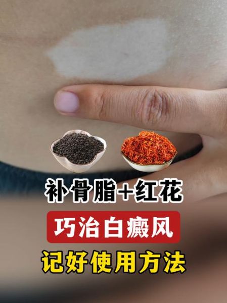 补骨脂酊治白斑效果怎么样_多久能见效-第2张图片-山城妙识