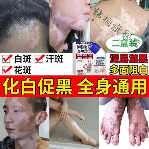 补骨脂酊治白斑效果怎么样_多久能见效-第3张图片-山城妙识