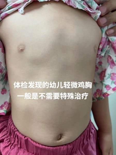 轻微鸡胸图片_轻微鸡胸怎么矫正-第1张图片-山城妙识