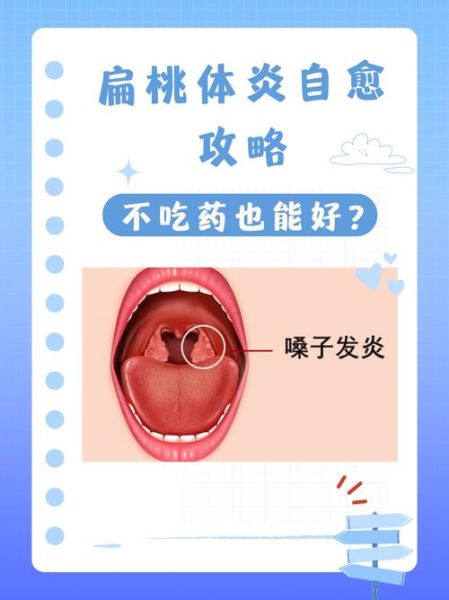 扁桃体发炎多喝水能自愈吗_需要几天-第1张图片-山城妙识