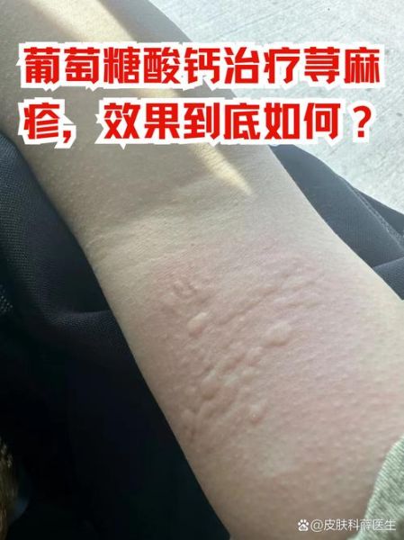 葡萄糖酸钙治荨麻疹效果怎么样_葡萄糖酸钙治疗荨麻疹用法用量-第1张图片-山城妙识 葡萄糖酸钙治荨麻疹效果怎么样_葡萄糖酸钙治疗荨麻疹用法用量-第1张图片-山城妙识