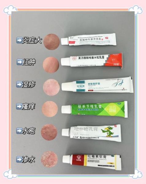 湿疹吃什么药效果最好_湿疹止痒药有哪些-第3张图片-山城妙识