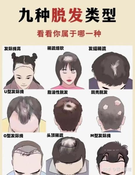 头顶秃了一小块怎么办_秃一小块会扩散吗-第2张图片-山城妙识 头顶秃了一小块怎么办_秃一小块会扩散吗-第2张图片-山城妙识