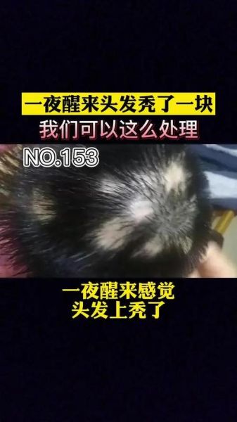 头顶秃了一小块怎么办_秃一小块会扩散吗-第3张图片-山城妙识 头顶秃了一小块怎么办_秃一小块会扩散吗-第3张图片-山城妙识