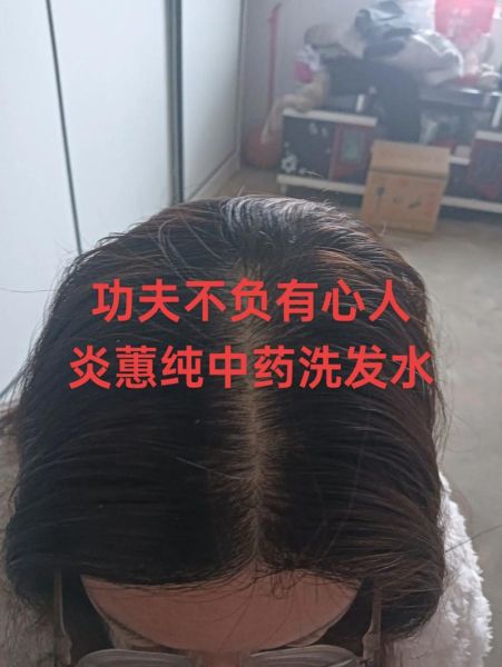 文慧洗头后掉发怎么办_文慧洗头后头皮痒怎么缓解-第2张图片-山城妙识 文慧洗头后掉发怎么办_文慧洗头后头皮痒怎么缓解-第2张图片-山城妙识