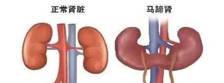马蹄肾是怎么回事_马蹄肾会影响寿命吗-第1张图片-山城妙识 马蹄肾是怎么回事_马蹄肾会影响寿命吗-第1张图片-山城妙识