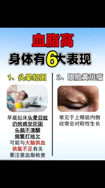 血脂高有什么症状_血脂高有哪些危害-第1张图片-山城妙识 血脂高有什么症状_血脂高有哪些危害-第1张图片-山城妙识