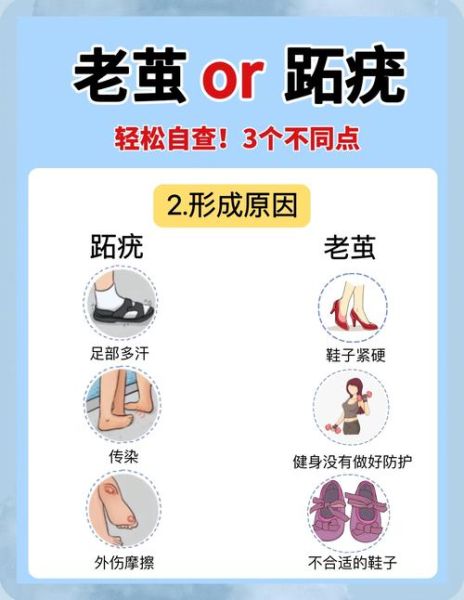 鸡眼图片大全大图_鸡眼和跖疣的区别是什么-第2张图片-山城妙识 鸡眼图片大全大图_鸡眼和跖疣的区别是什么-第2张图片-山城妙识