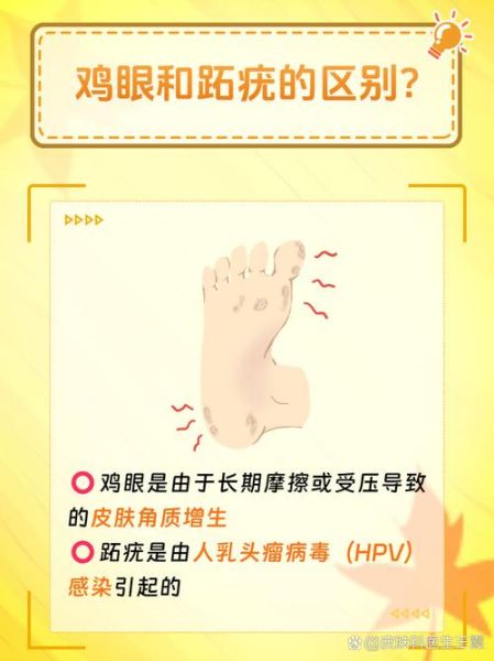 鸡眼图片大全大图_鸡眼和跖疣的区别是什么-第3张图片-山城妙识 鸡眼图片大全大图_鸡眼和跖疣的区别是什么-第3张图片-山城妙识