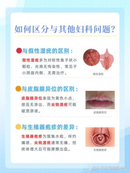 女性下面长菜花是什么原因_会传染吗-第1张图片-山城妙识 女性下面长菜花是什么原因_会传染吗-第1张图片-山城妙识