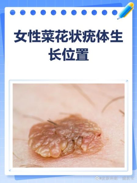 女性下面长菜花是什么原因_会传染吗-第2张图片-山城妙识 女性下面长菜花是什么原因_会传染吗-第2张图片-山城妙识