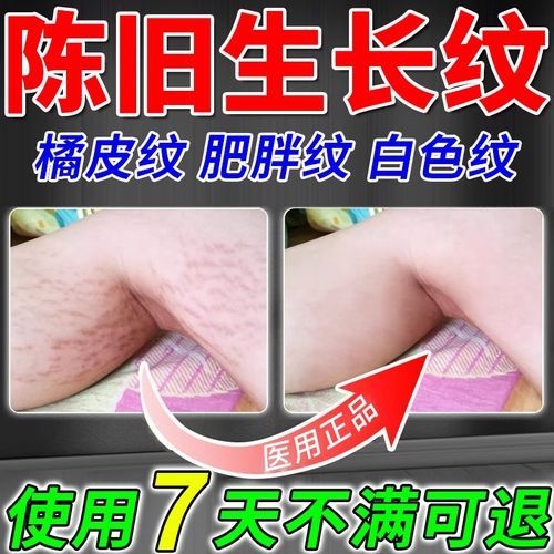 橘皮纹怎么消除_橘皮纹是什么原因-第1张图片-山城妙识