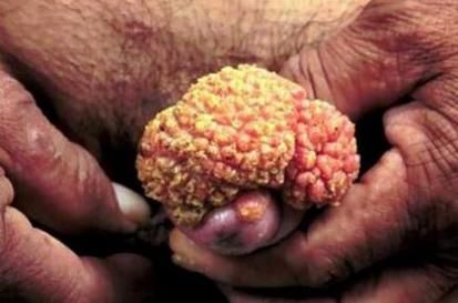 女性下面长菜花是什么原因_会传染吗-第3张图片-山城妙识 女性下面长菜花是什么原因_会传染吗-第3张图片-山城妙识