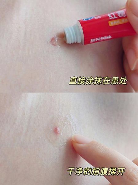 红霉素软膏的作用和功效_红霉素软膏可以涂痘痘吗-第1张图片-山城妙识 红霉素软膏的作用和功效_红霉素软膏可以涂痘痘吗-第1张图片-山城妙识