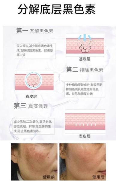 黑色素克星是什么_如何有效淡化色斑-第3张图片-山城妙识 黑色素克星是什么_如何有效淡化色斑-第3张图片-山城妙识