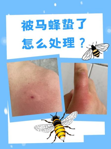 马蜂蛰了怎么快速消肿_马蜂蛰了止痒最有效的方法-第3张图片-山城妙识 马蜂蛰了怎么快速消肿_马蜂蛰了止痒最有效的方法-第3张图片-山城妙识
